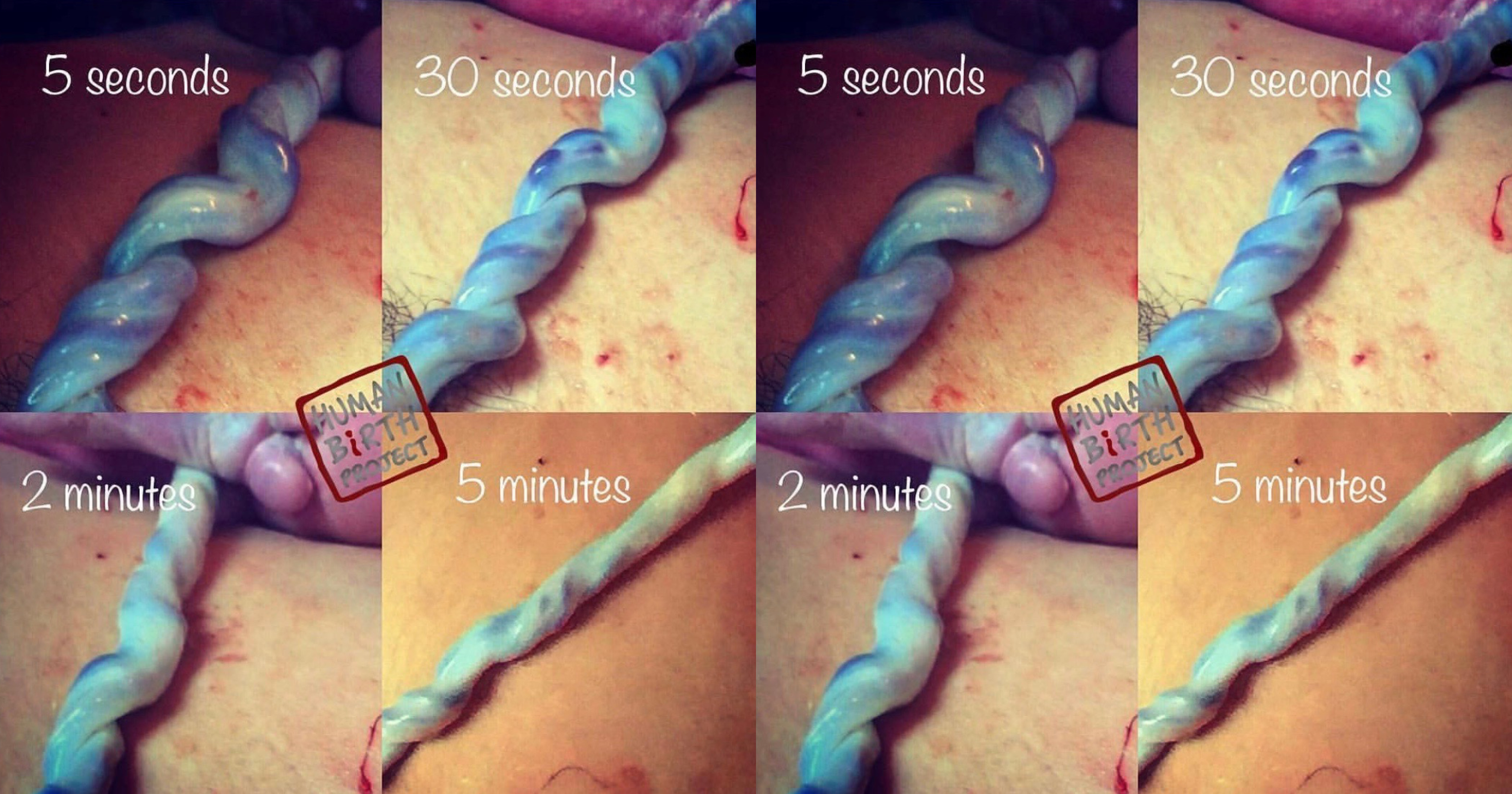 About Birth Articles Delayed Cord Clamping about-birth-articles-delayed-cord-clamping